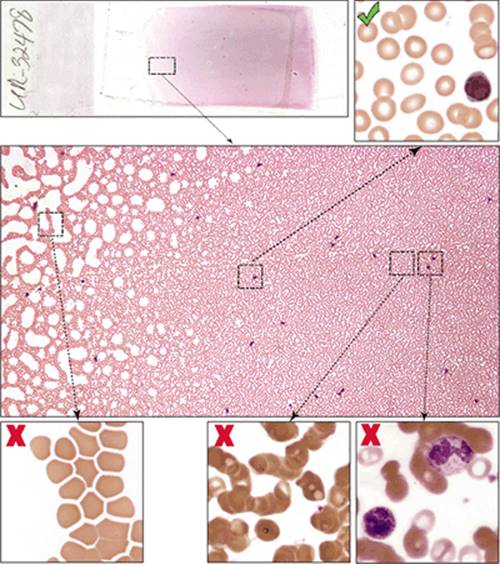 Approach to the Microscopic Evaluation of Blood and Bone Marrow ...