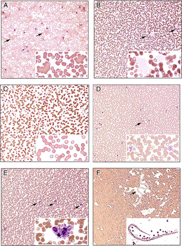 Approach to the Microscopic Evaluation of Blood and Bone Marrow ...