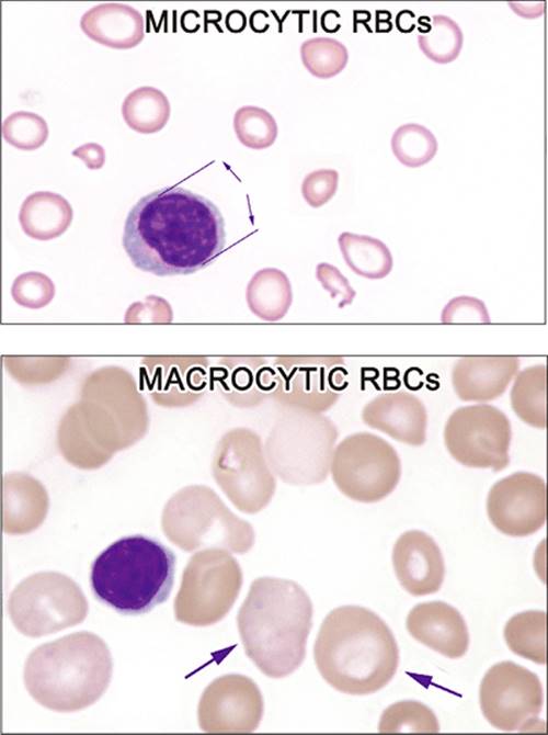 Approach to the Microscopic Evaluation of Blood and Bone Marrow ...