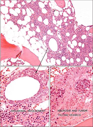 Approach to the Microscopic Evaluation of Blood and Bone Marrow ...