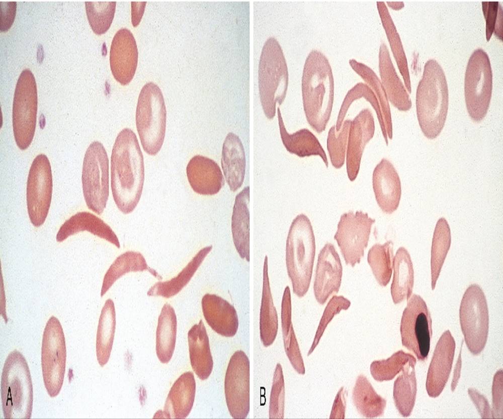 Hemoglobinopathies (structural defects in hemoglobin) - Rodak's ...