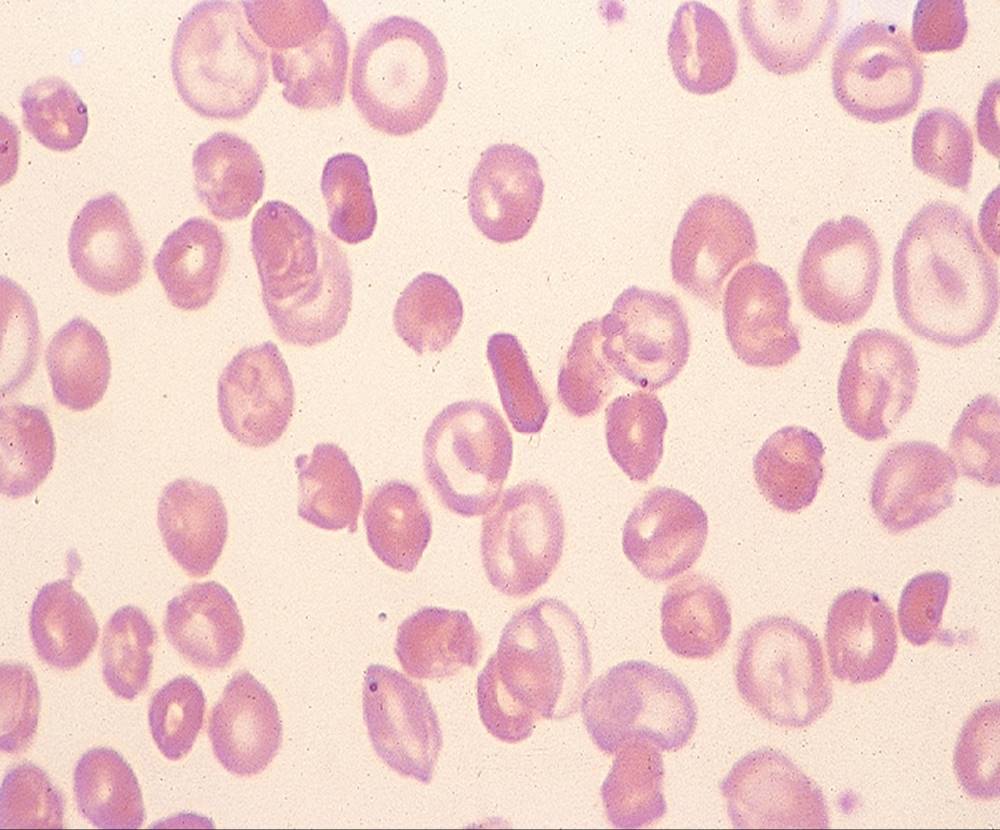 Hemoglobinopathies (structural defects in hemoglobin) - Rodak's ...