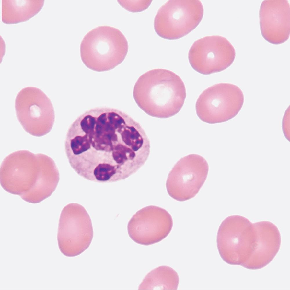 Nonmalignant leukocyte disorders - Rodak's Hematology: Clinical ...