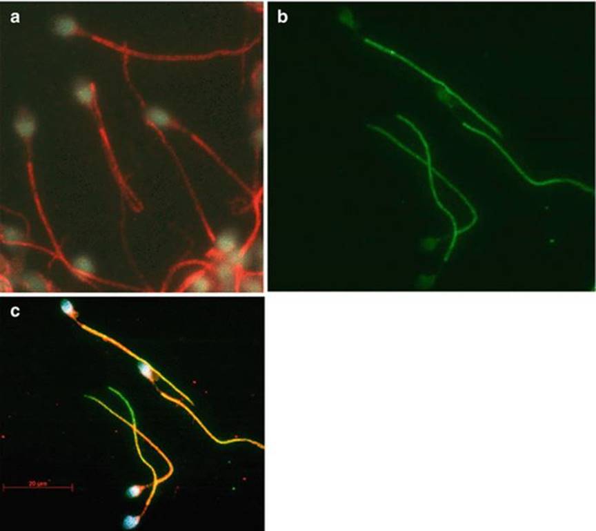 Sperm Functions Influenced by Immune Reactions - Immune Infertility ...