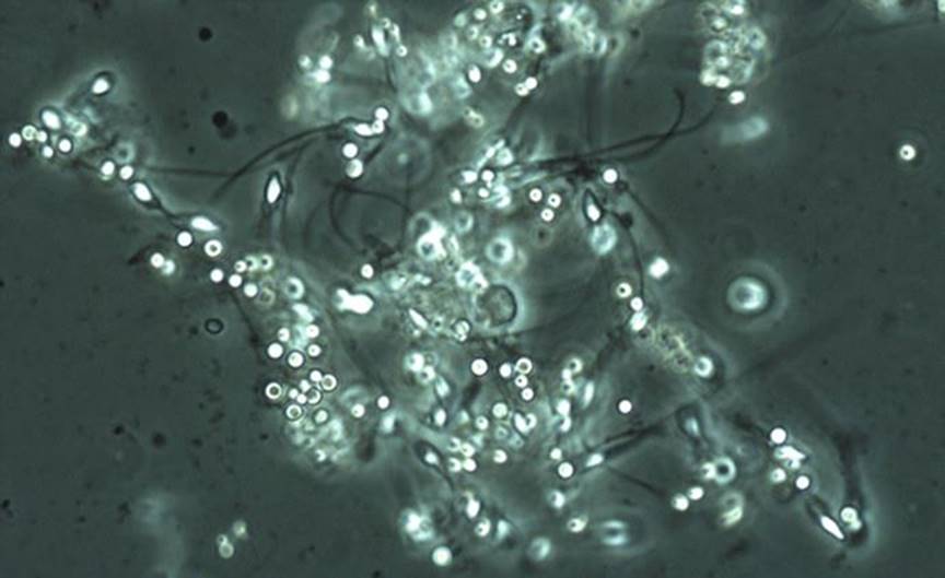 Tests for Sperm Antibodies - Immune Infertility: Impact of Immune ...