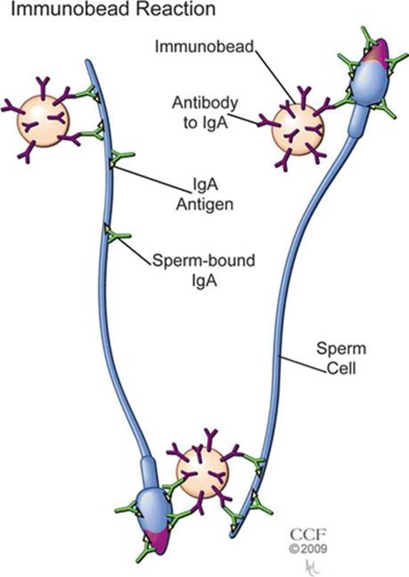 Tests for Sperm Antibodies - Immune Infertility: Impact of Immune ...