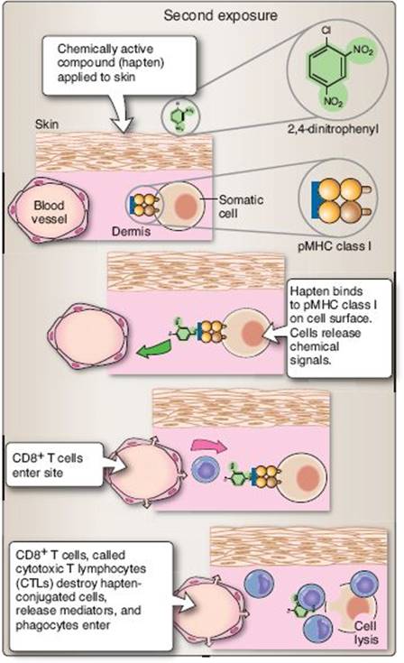 Hypersensitivity Reactions - Lippincott Illustrated Reviews: Immunology ...