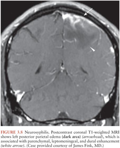 Imaging of Intracranial Infections - APPROACH TO THE PATIENT ...