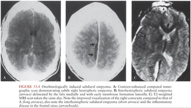 Subdural Empyema and Suppurative Intracranial Phlebitis - BACTERIAL AND ...