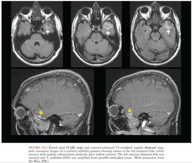 Neurosyphilis - SPIROCHETAL INFECTIONS - Infections of the Central ...