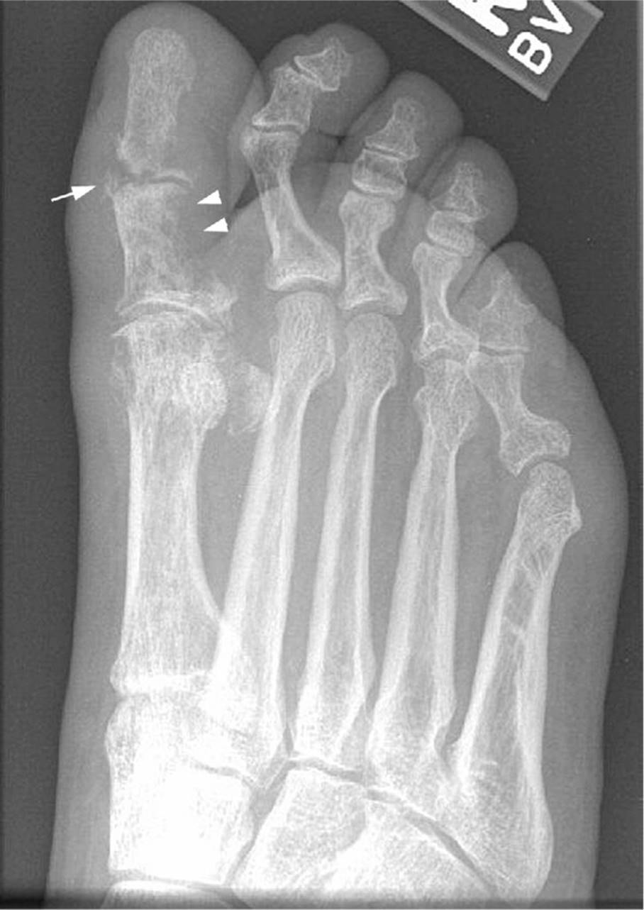 Osteomyelitis, Prosthetic Joint Infections, Diabetic Foot Infections ...