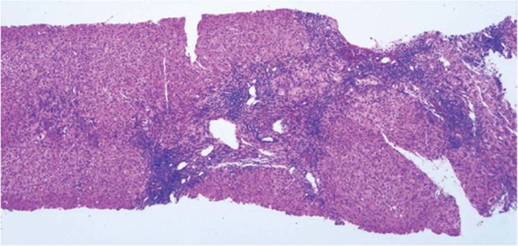 Chronic Hepatitis (Chronic Necroinflammatory Disease of the Liver ...