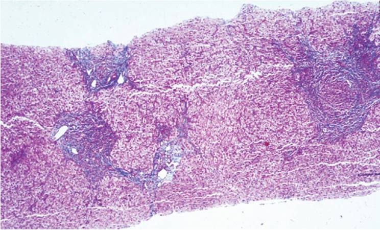 Chronic Hepatitis (Chronic Necroinflammatory Disease of the Liver ...