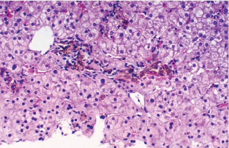 The Liver in Systemic Disorders - Biopsy Interpretation of the Liver ...