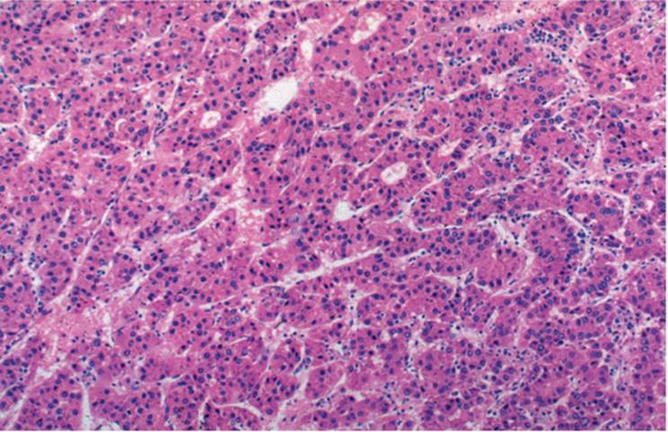Primary and Metastatic Malignant Tumors of the Liver - Biopsy ...
