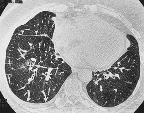 Interstitial Lung Disease - Chest Radiology: The Essentials, 2nd Edition