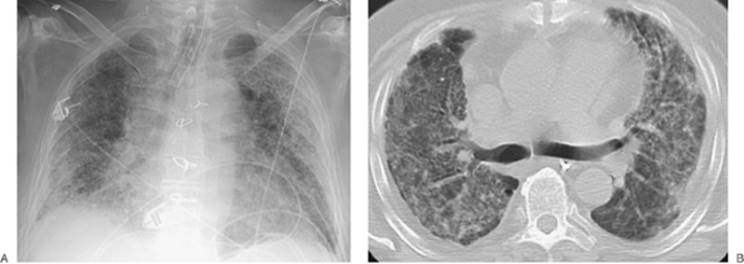 Alveolar Lung Disease - Chest Radiology: The Essentials, 2nd Edition