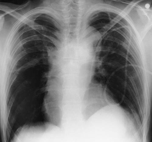 Monitoring and Support Devices - "Tubes and Lines" - Chest Radiology ...