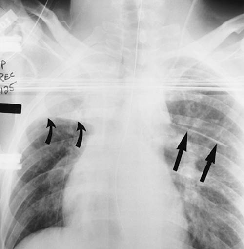 Monitoring and Support Devices - "Tubes and Lines" - Chest Radiology ...