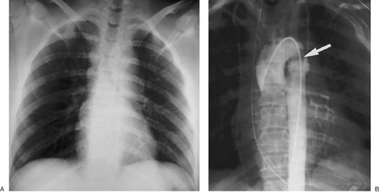 Chest Trauma - Chest Radiology: The Essentials, 2nd Edition