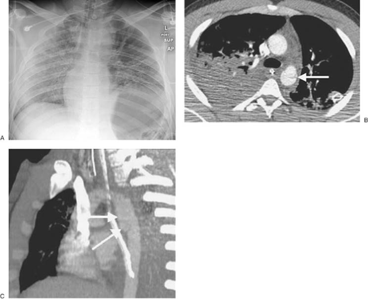 Chest Trauma - Chest Radiology: The Essentials, 2nd Edition