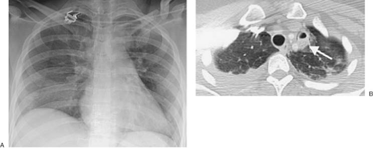 Chest Trauma - Chest Radiology: The Essentials, 2nd Edition