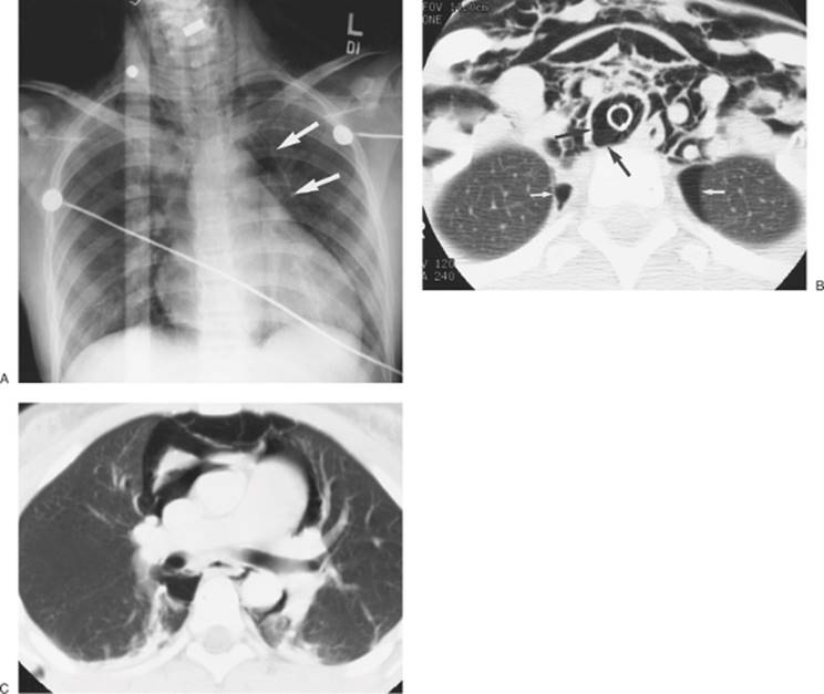 Chest Trauma - Chest Radiology: The Essentials, 2nd Edition
