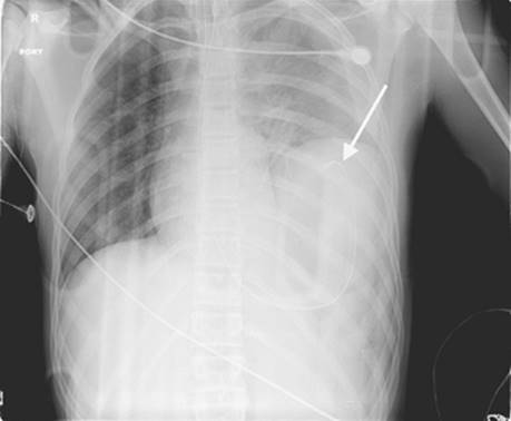 Chest Trauma - Chest Radiology: The Essentials, 2nd Edition