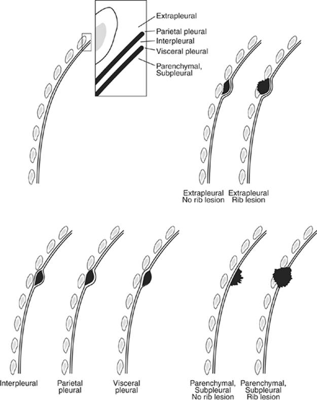Pleura, Chest Wall, and Diaphragm - Chest Radiology: The Essentials ...