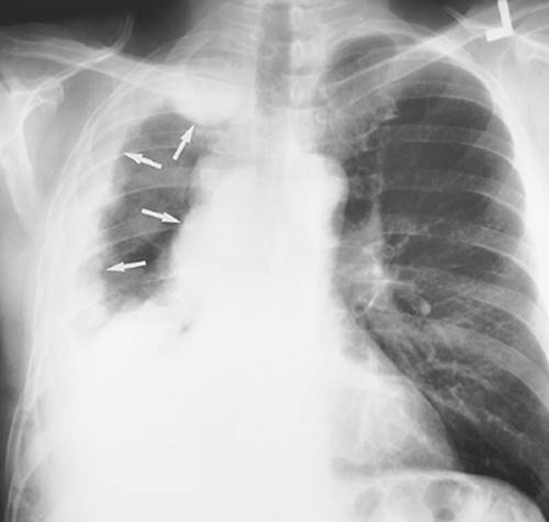 Pleura, Chest Wall, and Diaphragm - Chest Radiology: The Essentials ...