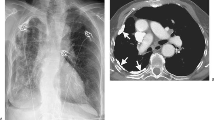 Pleura, Chest Wall, and Diaphragm - Chest Radiology: The Essentials ...