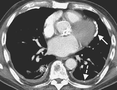 Pleura, Chest Wall, and Diaphragm - Chest Radiology: The Essentials ...