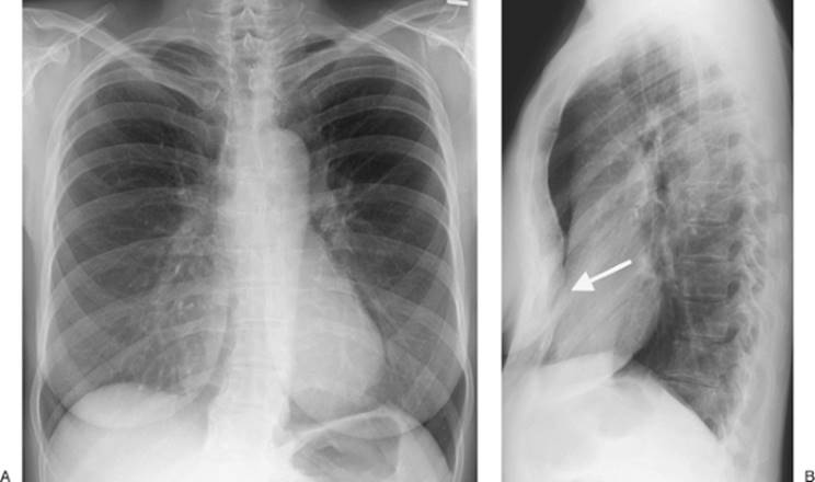 Pleura, Chest Wall, and Diaphragm - Chest Radiology: The Essentials ...