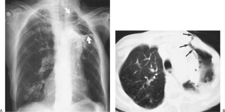 Pleura, Chest Wall, and Diaphragm - Chest Radiology: The Essentials ...