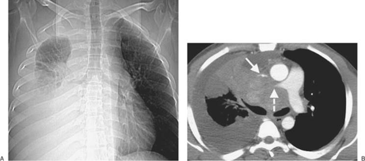 Upper Lung Disease, Infection, and Immunity - Chest Radiology: The ...