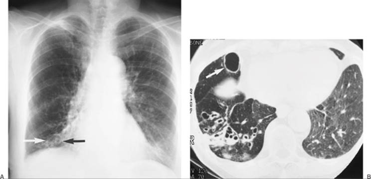 Airways - Chest Radiology: The Essentials, 2nd Edition