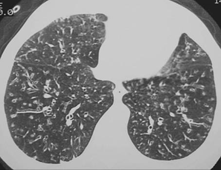 Airways - Chest Radiology: The Essentials, 2nd Edition
