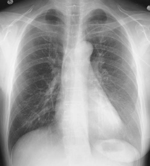 Unilateral Hyperlucent Hemithorax - Chest Radiology: The Essentials ...