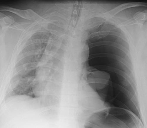 Unilateral Hyperlucent Hemithorax - Chest Radiology: The Essentials ...