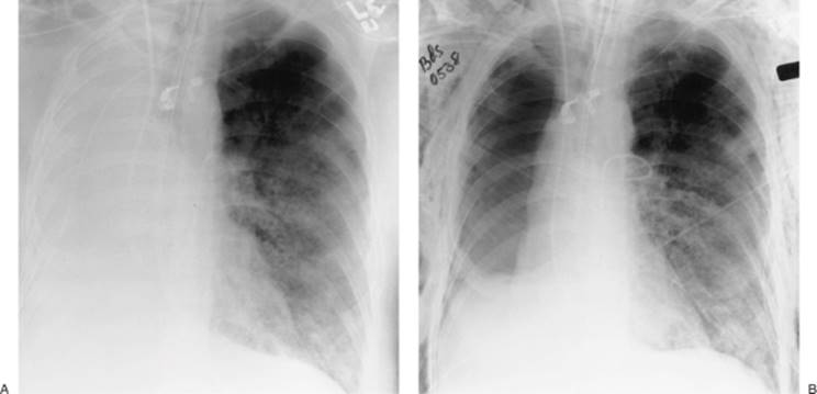 Neoplasms of the Lung - Chest Radiology: The Essentials, 2nd Edition