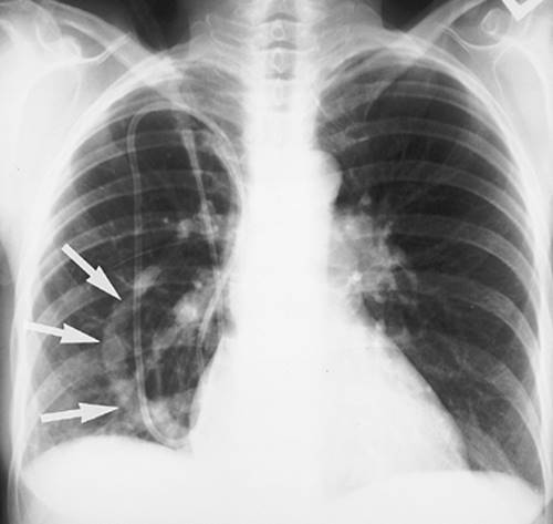 Congenital Lung Disease - Chest Radiology: The Essentials, 2nd Edition