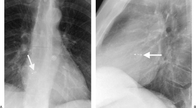 Congenital and Acquired Cardiac Disease - Chest Radiology: The ...