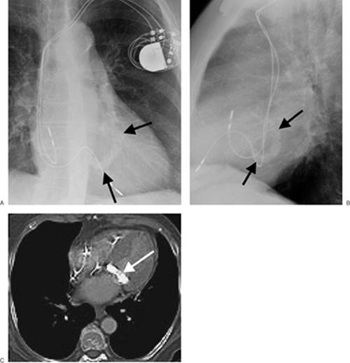 Congenital and Acquired Cardiac Disease - Chest Radiology: The ...