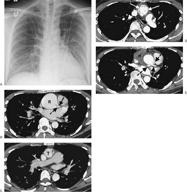 Thoracic Aorta - Chest Radiology: The Essentials, 2nd Edition