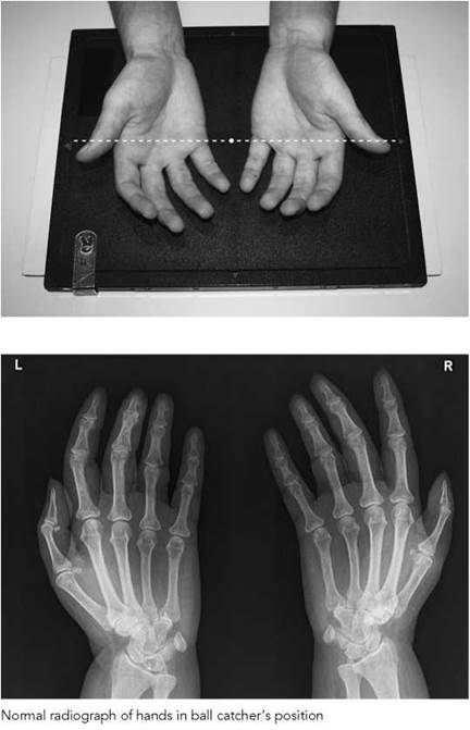 The Upper Limb - Clark's Positioning In Radiography - by A. S. Whitley