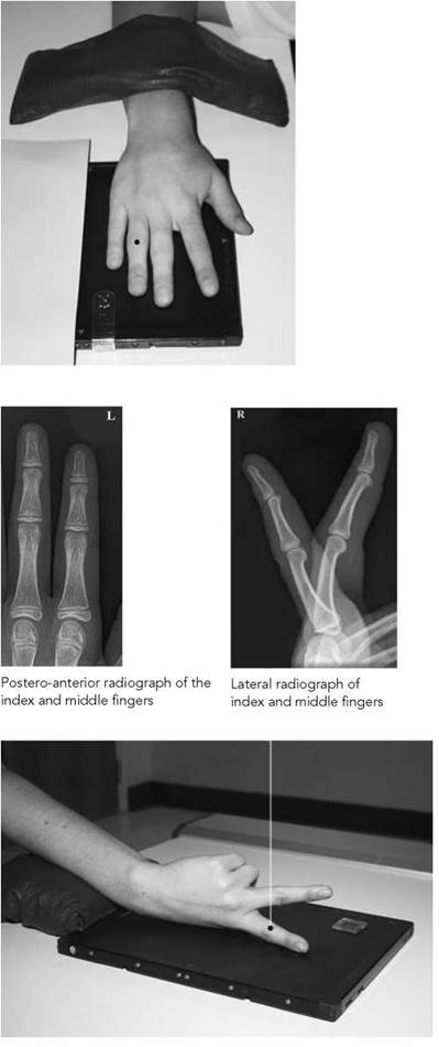 The Upper Limb - Clark's Positioning In Radiography - by A. S. Whitley