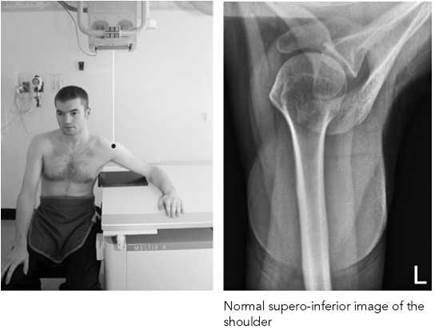 The Shoulder - Clark's Positioning In Radiography - by A. S. Whitley