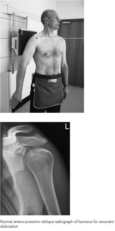 The Shoulder - Clark's Positioning In Radiography - by A. S. Whitley