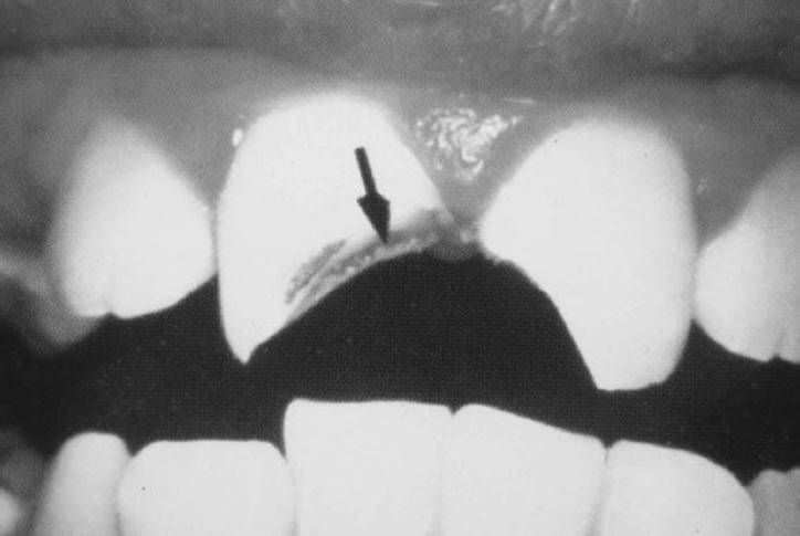 Dental Injuries - Trauma - Harwood-Nuss' Clinical Practice of Emergency ...