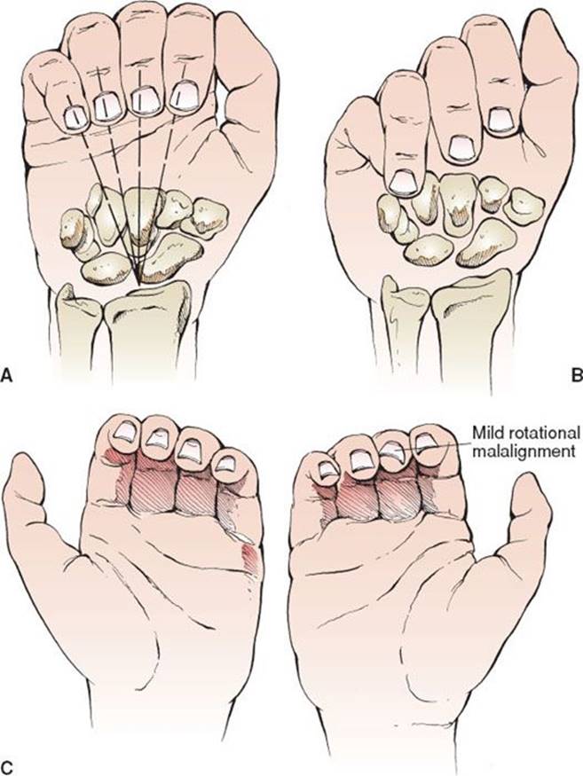 Hand Injuries - Trauma - Harwood-Nuss' Clinical Practice of Emergency ...